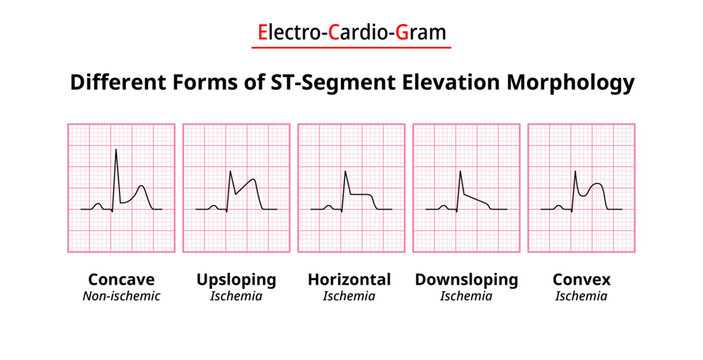 St Segment Elevation