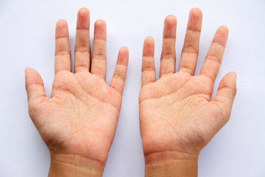 Petechien-Bilder: Stock-Fotos & -Videos. | Adobe Stock