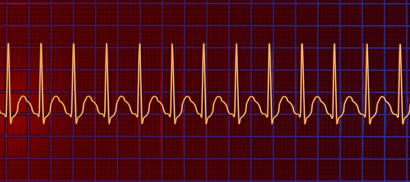 Paroxysmal Supraventricular Tachycardia Ecg