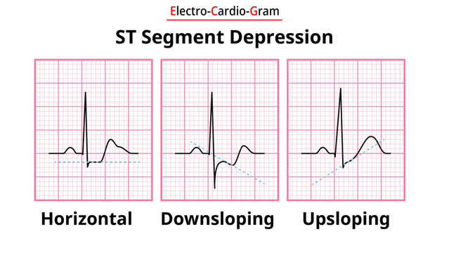 Fototapeta: Inferior STEMI (ST-Elevation Myocardial Infarction) - The ...