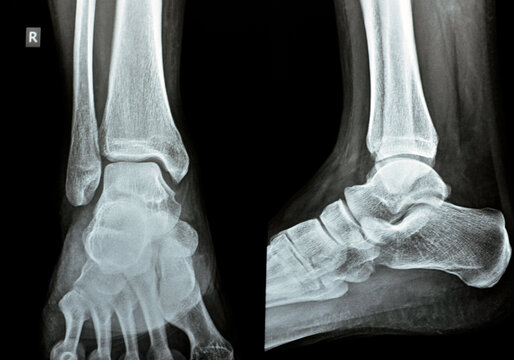 X Ray Ankle Ap Foot, Ankle, And Calf | Radiology Key