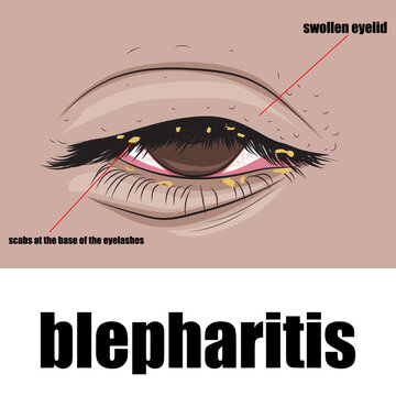 Blefarit bilder – Bläddra bland 1,184 stockfoton, vektorer och videor ...