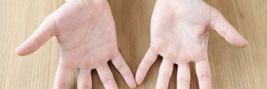 「Callosity」の写真素材 | 33,487件の無料イラスト画像 | Adobe Stock