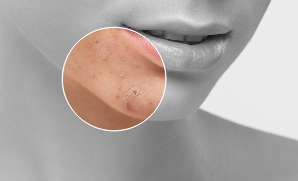 Demodicosis Images – Browse 441 Stock Photos, Vectors, and Video ...