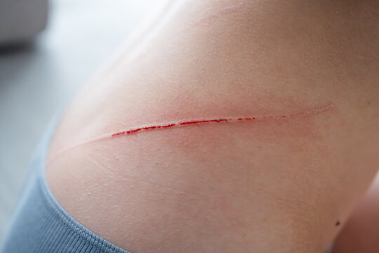 "Flesh Wound" Bilder – Durchsuchen 258 Archivfotos, Vektorgrafiken und ...