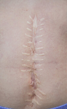 "Body Scar" Images – Browse 14 Stock Photos, Vectors, and Video | Adobe ...