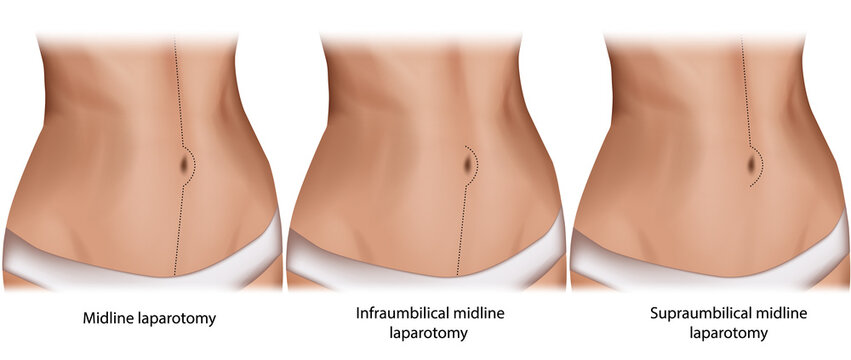 open midline laparotomy