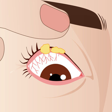 Blefarit bilder – Bläddra bland 1,184 stockfoton, vektorer och videor ...