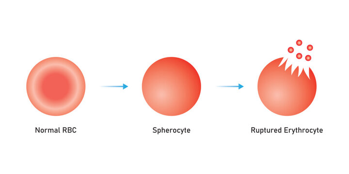 รูปภาพSpherocyte – เลือกดูภาพถ่ายสต็อก เวกเตอร์ และวิดีโอ291 | Adobe Stock