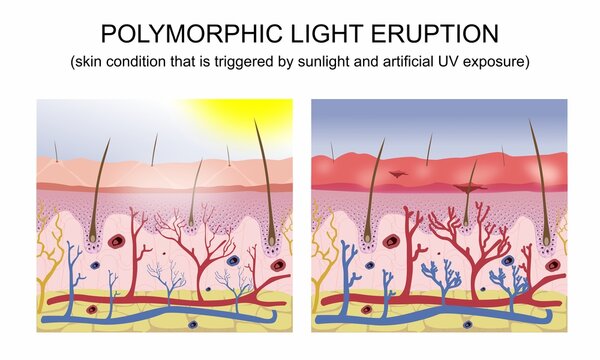 "Polymorphic Light Eruption" Images – Browse 142 Stock Photos, Vectors ...