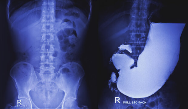Barium Swallow Oesophagus Templates – Free Editable Designs | PikWizard