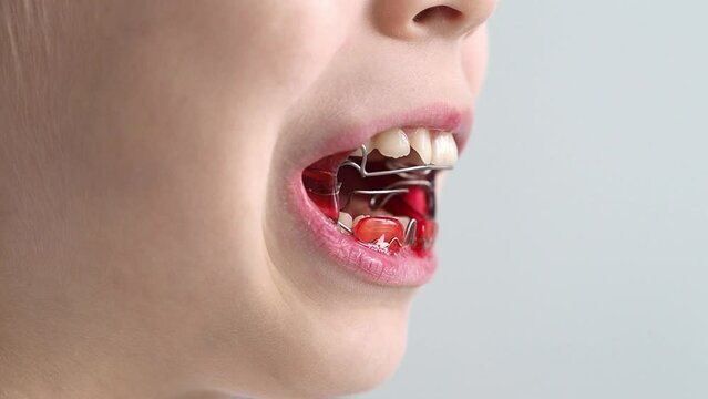 "Orthodontic Appliance" Images – Browse 2,097 Stock Photos, Vectors ...