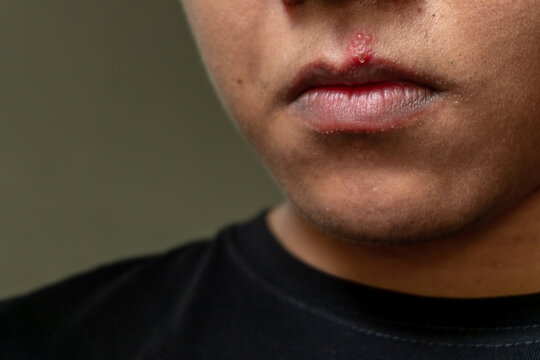 "Blisters Crust" Images – Browse 108 Stock Photos, Vectors, and Video ...