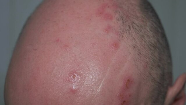 "Herpes Zoster" Images – Browse 85,210 Stock Photos, Vectors, and Video ...