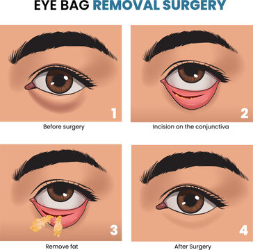 Bindehautsack Bilder – Durchsuchen 2,279 Archivfotos, Vektorgrafiken ...
