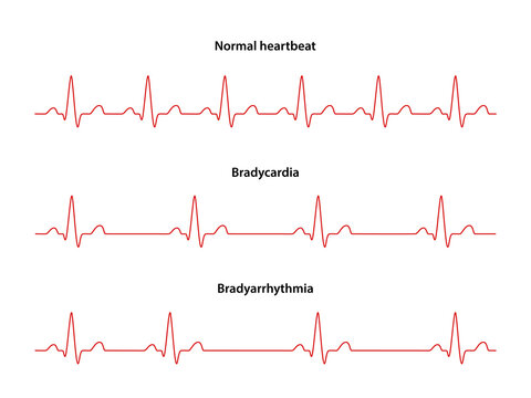 Bradycardia Images – Browse 1,807 Stock Photos, Vectors, and Video ...