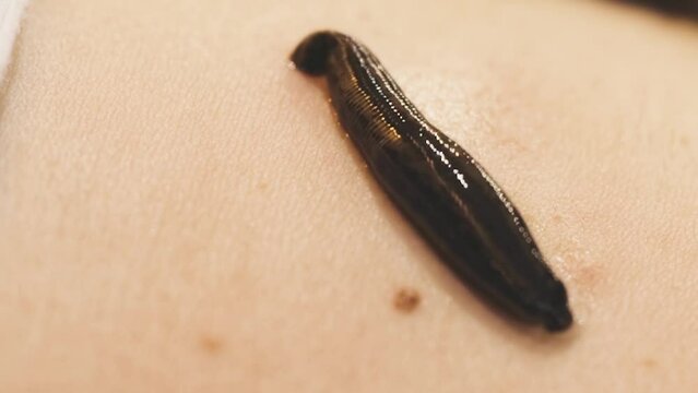 "Medical Leech" Images – Browse 1,805 Stock Photos, Vectors, and Video ...