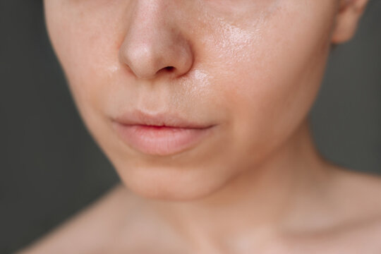 "Oily Skin"-Bilder: Stock-Fotos & -Videos. | Adobe Stock