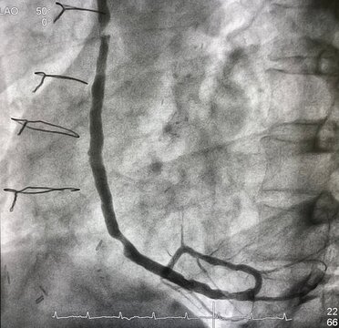 "Coronary Angiogram" Imagens – Procure 742 fotos, vetores e vídeos ...