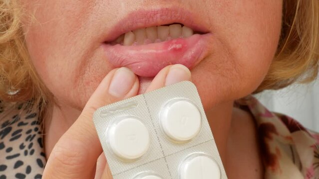 「Aphthous」の写真素材 | 418件の無料イラスト画像 | Adobe Stock