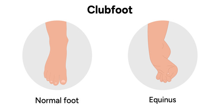 Clubfoot Images – Browse 1,781 Stock Photos, Vectors, and Video | Adobe ...
