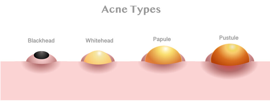 Acne Skin Diagram Images – Browse 1,349 Stock Photos, Vectors, and ...