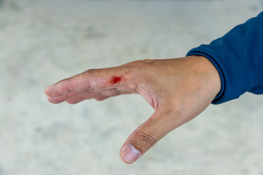 Dog Bite Hand Infection