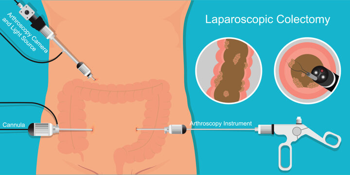 Colectomy Images – Browse 156 Stock Photos, Vectors, and Video | Adobe ...