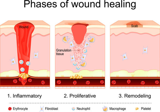 Wound Healing Process Images – Browse 85,212 Stock Photos, Vectors, and ...
