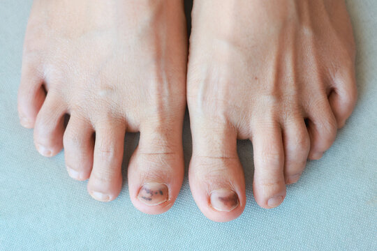 Subungual Hematoma"」の写真素材 | 302件の無料イラスト画像 | Adobe Stock