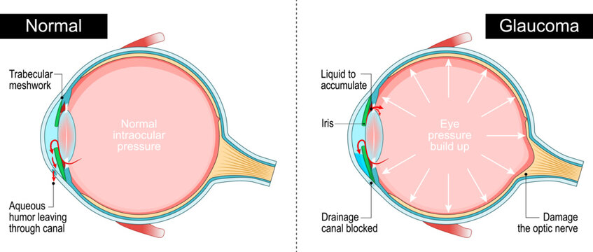 Aqueous Humor In Eye