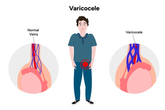 「Varicocele」の写真素材 | 459件の無料イラスト画像 | Adobe Stock
