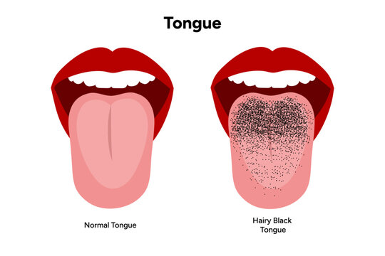 "Black Hairy Tongue" Images – Browse 490 Stock Photos, Vectors, and ...