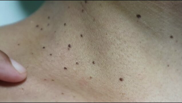 Acrochordons - Images et vidéos libres de droits | Adobe Stock