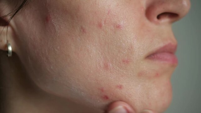 Pustules Images – Browse 1,129,385 Stock Photos, Vectors, and Video ...