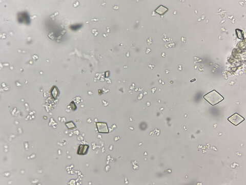 Calcium Oxalate Monohydrate Crystals