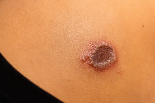 "Blister Beetle" Images – Browse 1,704 Stock Photos, Vectors, and Video ...