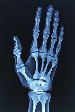 "Amputated Finger" Images – Browse 26 Stock Photos, Vectors, and Video ...