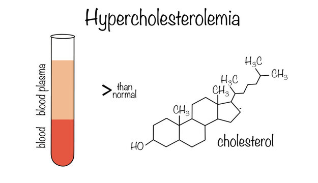 Hypercholesterolemia Images – Browse 4,796 Stock Photos, Vectors, and ...