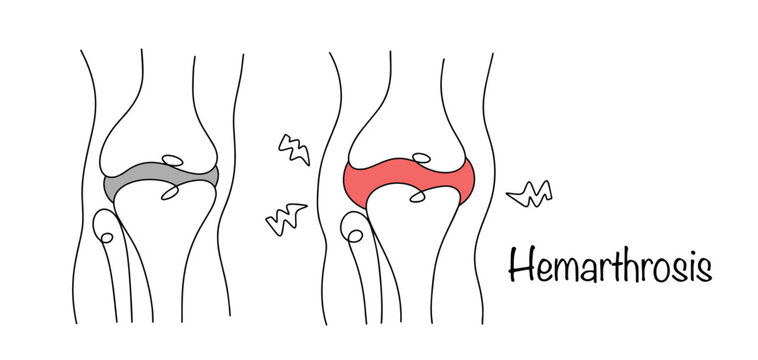 Hemarthrosis Images – Browse 99 Stock Photos, Vectors, and Video ...