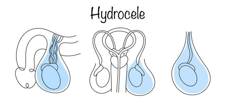 Hydrocele Images – Browse 495 Stock Photos, Vectors, and Video | Adobe ...