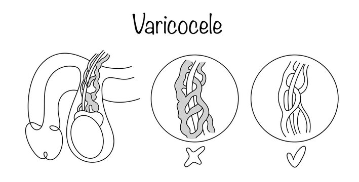 Varicocele Images – Browse 588 Stock Photos, Vectors, and Video | Adobe ...