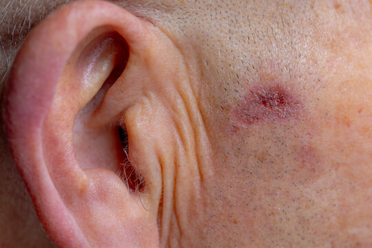 Basaliom bilder – Bläddra bland 706 stockfoton, vektorer och videor ...