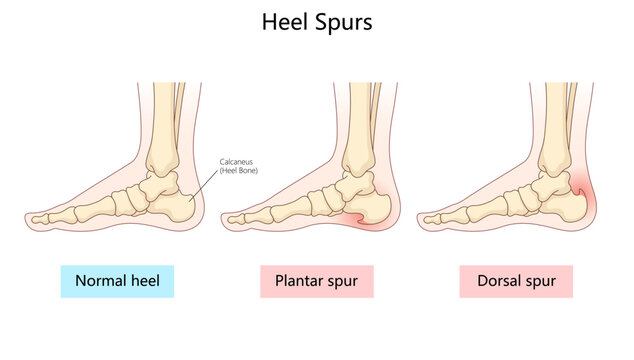 "Heel Spur" Images – Browse 1,142 Stock Photos, Vectors, and Video ...