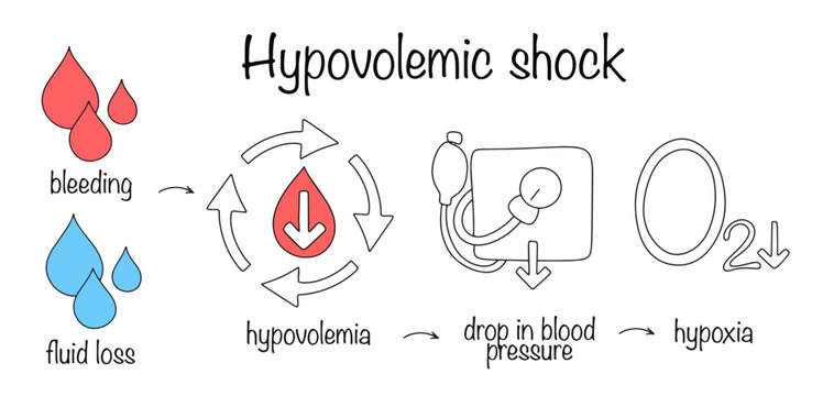 "Hypovolemic Shock" Images – Browse 53 Stock Photos, Vectors, and Video ...