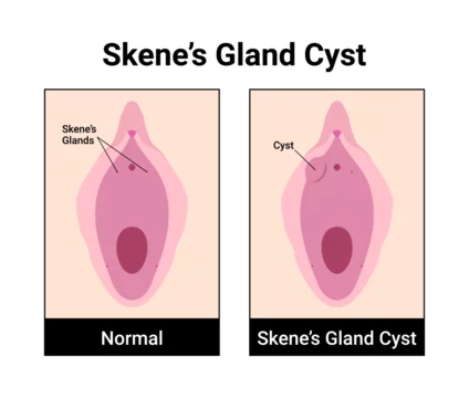 Skenes Glands Diagram The Female Reproductive System – Boundless