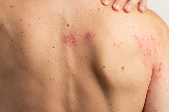 「帯状疱疹」の写真素材 | 135,773件の無料イラスト画像 | Adobe Stock