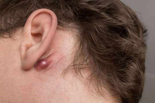 boil behind ear